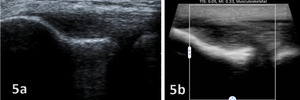Diagnostic Musculoskeletal Ultrasound for the Evaluation of the Lateral ...