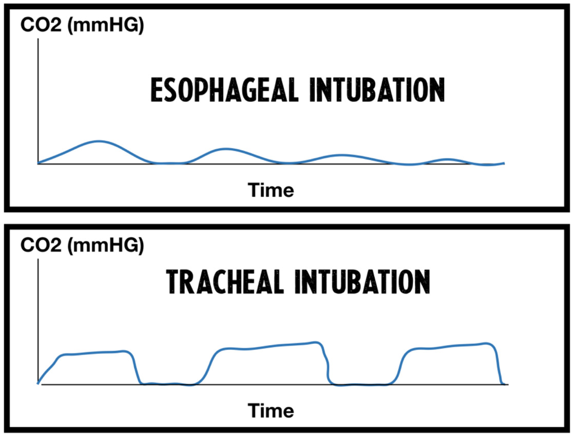 Top 10 Facts You Need to Know About Intubation | Published in Journal ...