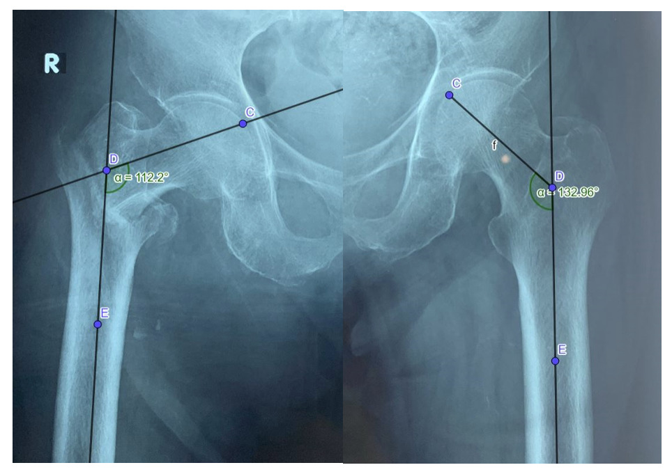 THE RETROSPECTIVE ANALYSIS OF TRIGEN INTERTAN NAIL IN THE TREATMENT OF ...