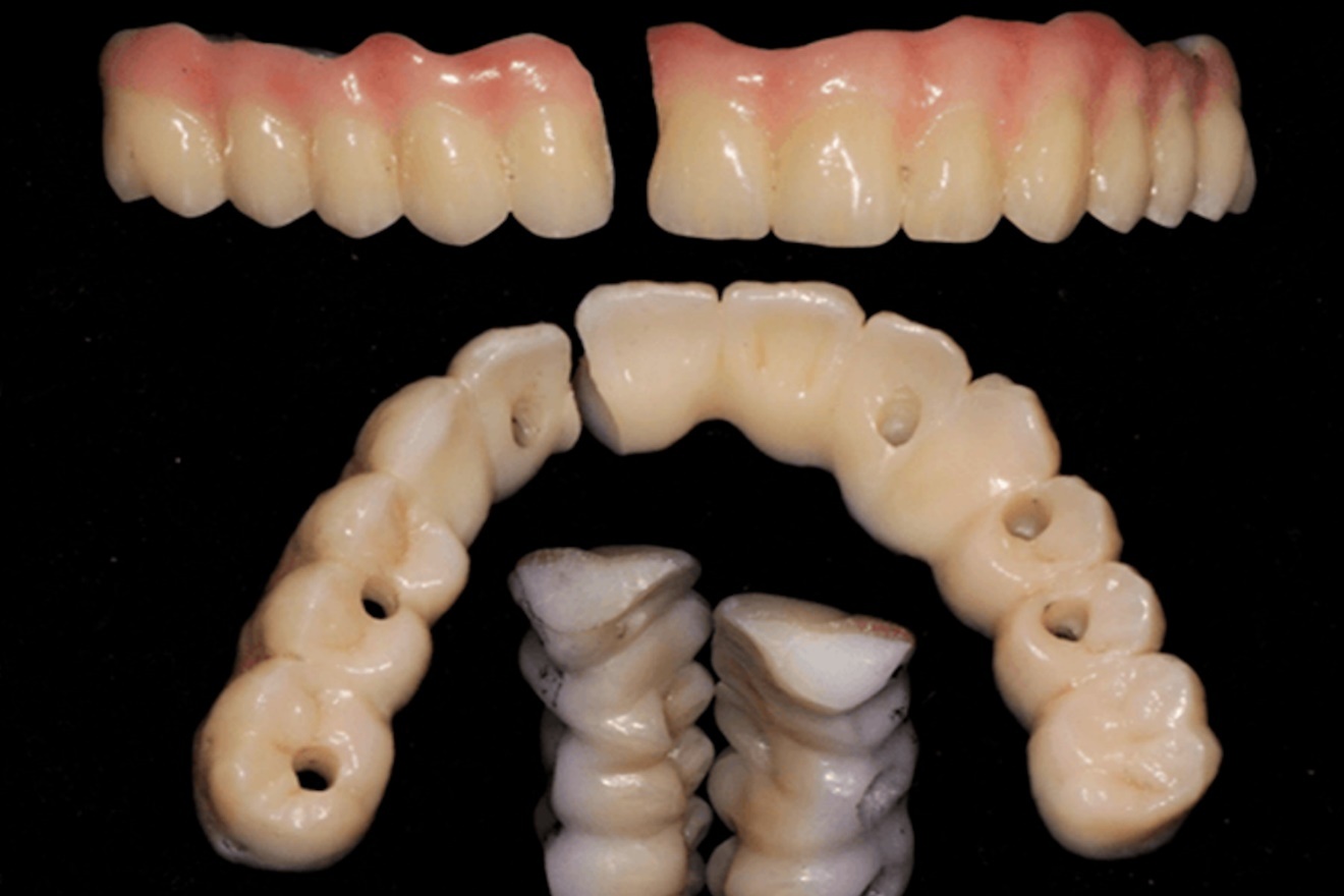 Implant Complications After Installation with Traditional Vs Digital ...