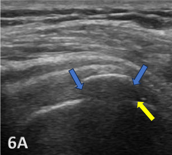 Utilizing Diagnostic Musculoskeletal Ultrasound for Assessment of the ...