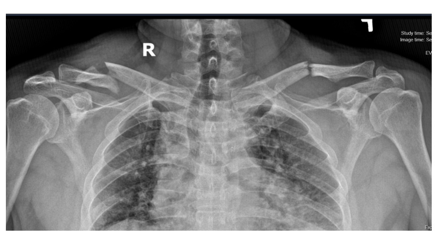 MIMINALLY INVASIVE OSTEOSYSTHESIS FOR BILATERAL CLAVICLE MIDSHAFT ...