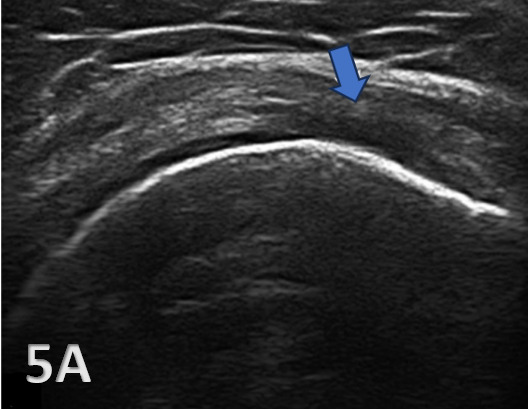 Utilizing Diagnostic Musculoskeletal Ultrasound for Assessment of the ...