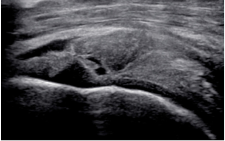 The Application of Musculoskeletal Ultrasound in the Diagnosis of ...