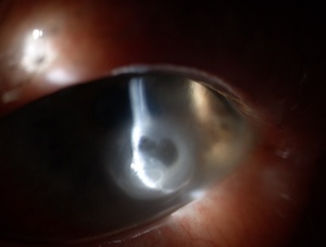 The healing power of amniotic membrane extract eye drops. A 100 year ...