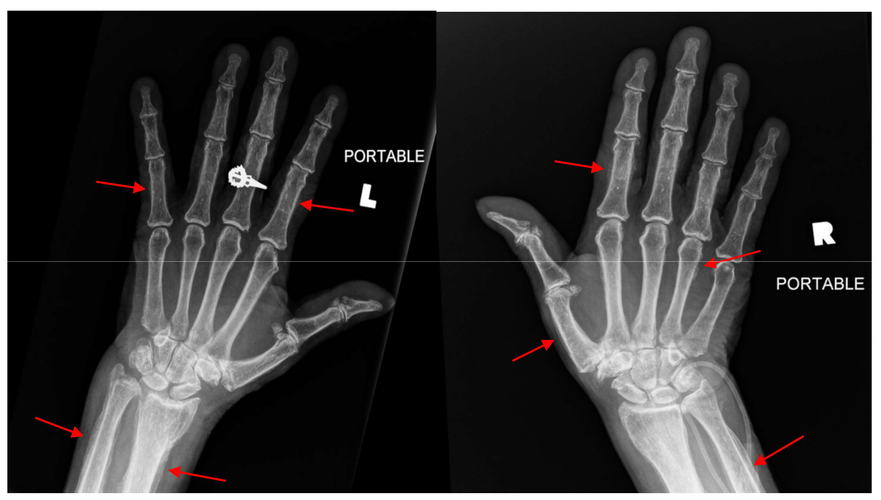 Hypertrophic Pulmonary Osteoarthropathy - An Overlooked Clue of Lung ...
