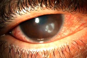 Case Report of Corneal Ulceration Associated With Dupilumab | Published ...