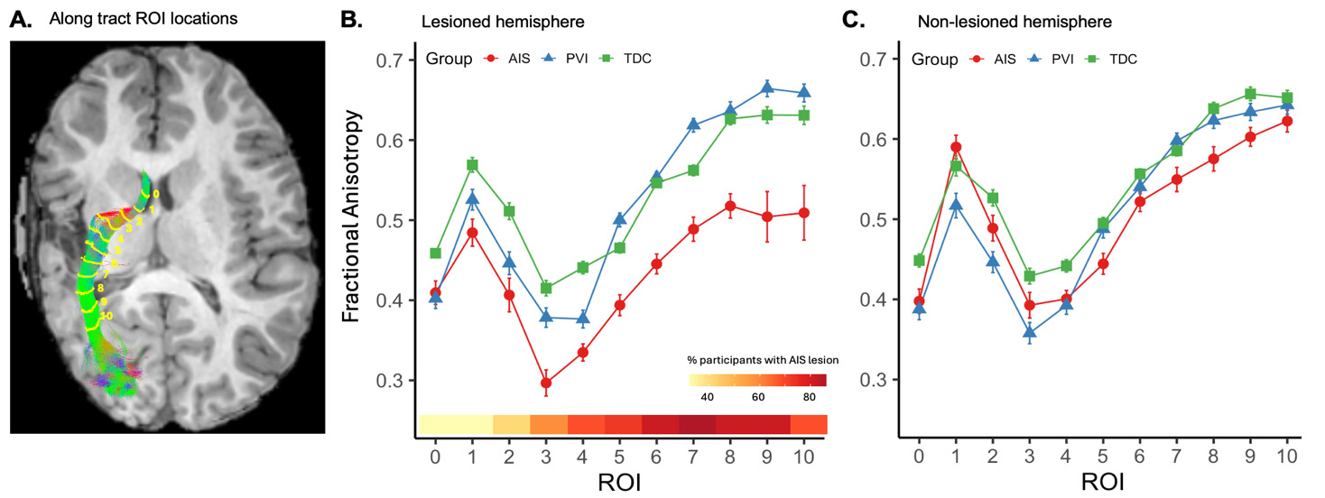 Bilateral differences in structural connectivity of the afferent visual ...