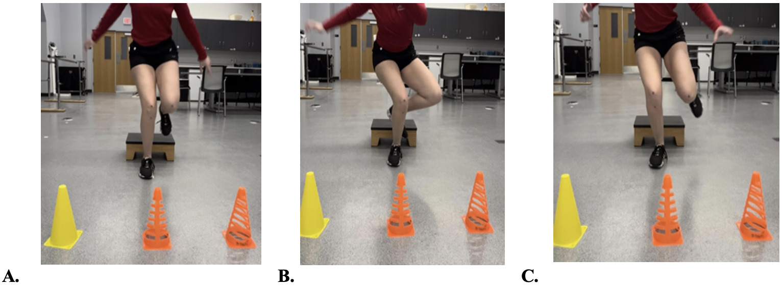 Are We Overlooking Anatomical Contributions to Dynamic Knee Valgus ...