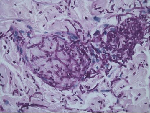 Isavuconazole Breakthrough Disseminated Fusarium fujikuroi Infection in ...