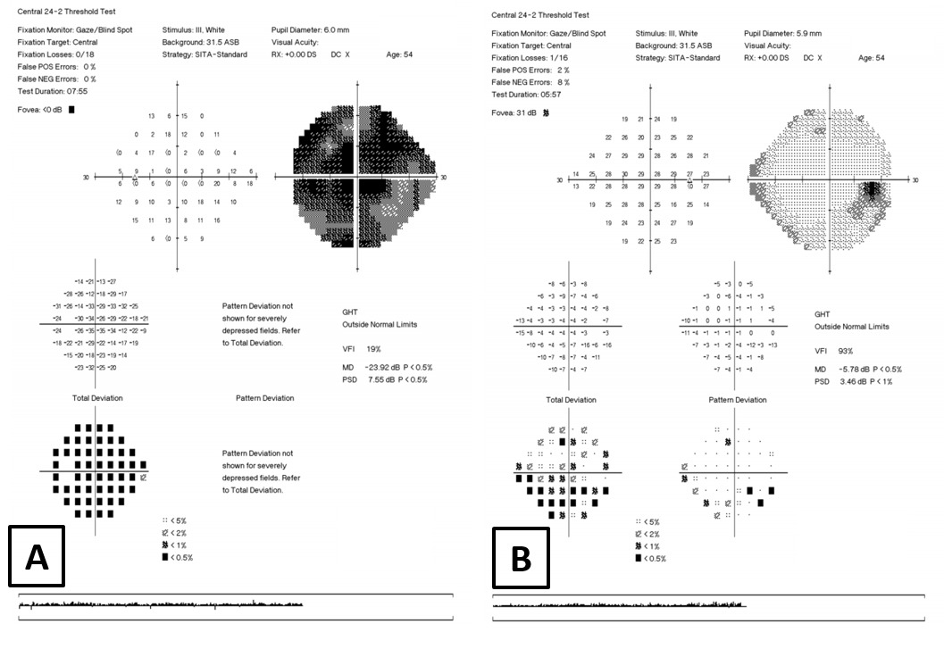 Case Report: Retinal Artery Occlusion Associated with Patent Foramen ...