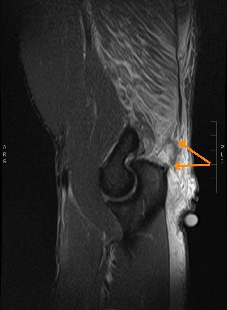 Triceps Tendon Avulsion in a Soldier: A Case Report | Published in ...