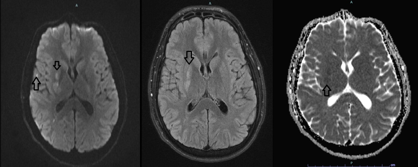 Unexplained Stroke and Multifocal Intracranial Stenosis due to ...