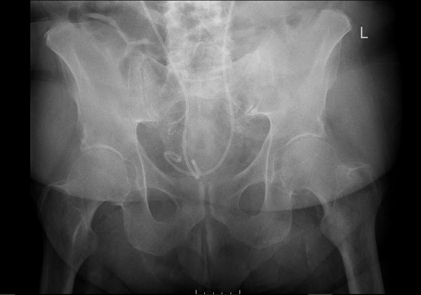 Pelvic Abscess with Presentation as Inability to Ambulate | Published ...