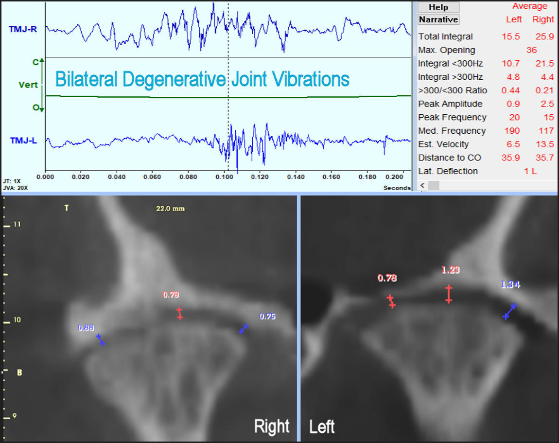 Joint Vibration Analysis (JVA) Bridges the Gap between Clinical ...
