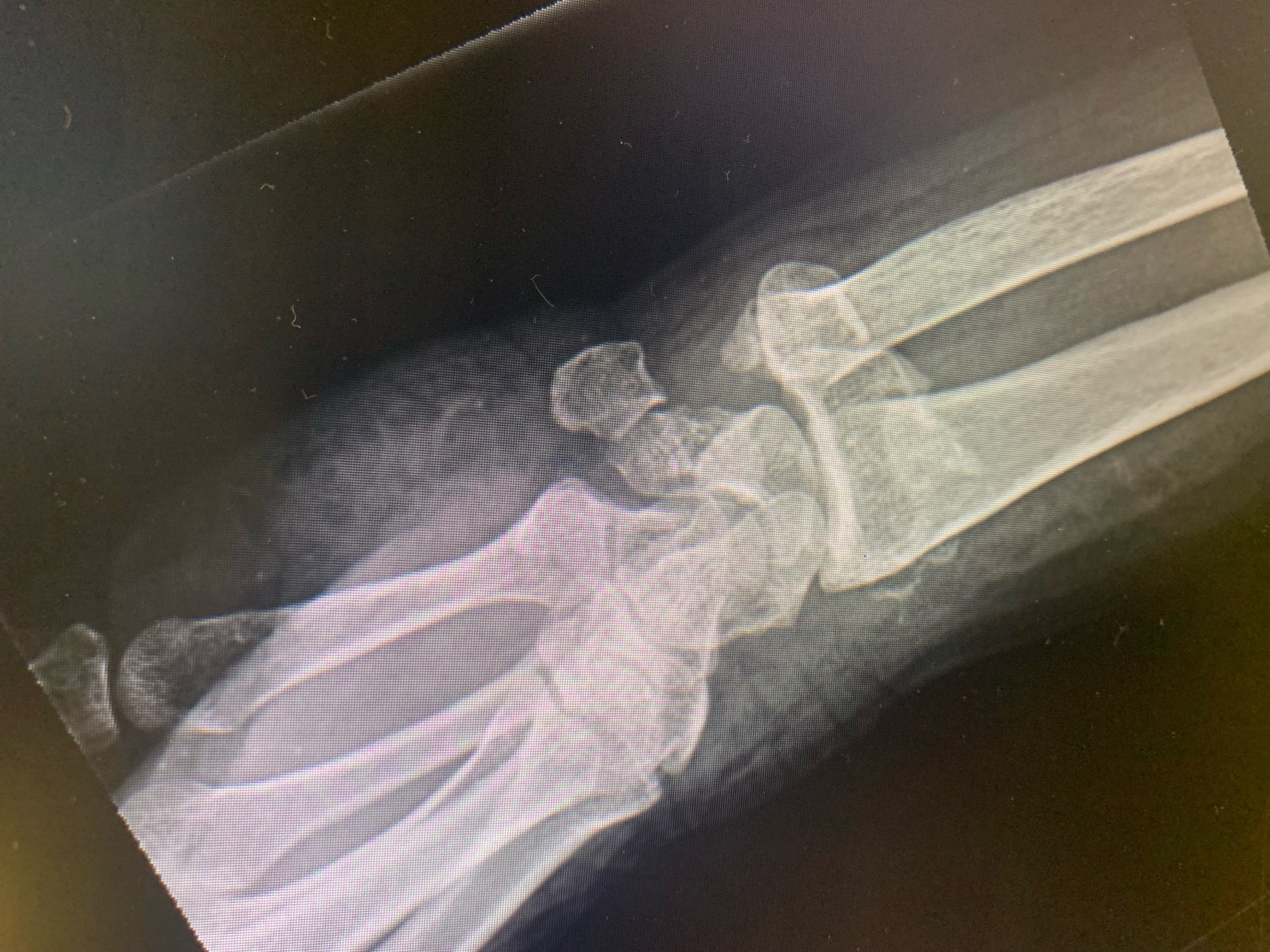 Distal Radius Fracture with Dislocation of the Radioulnar Joint ...