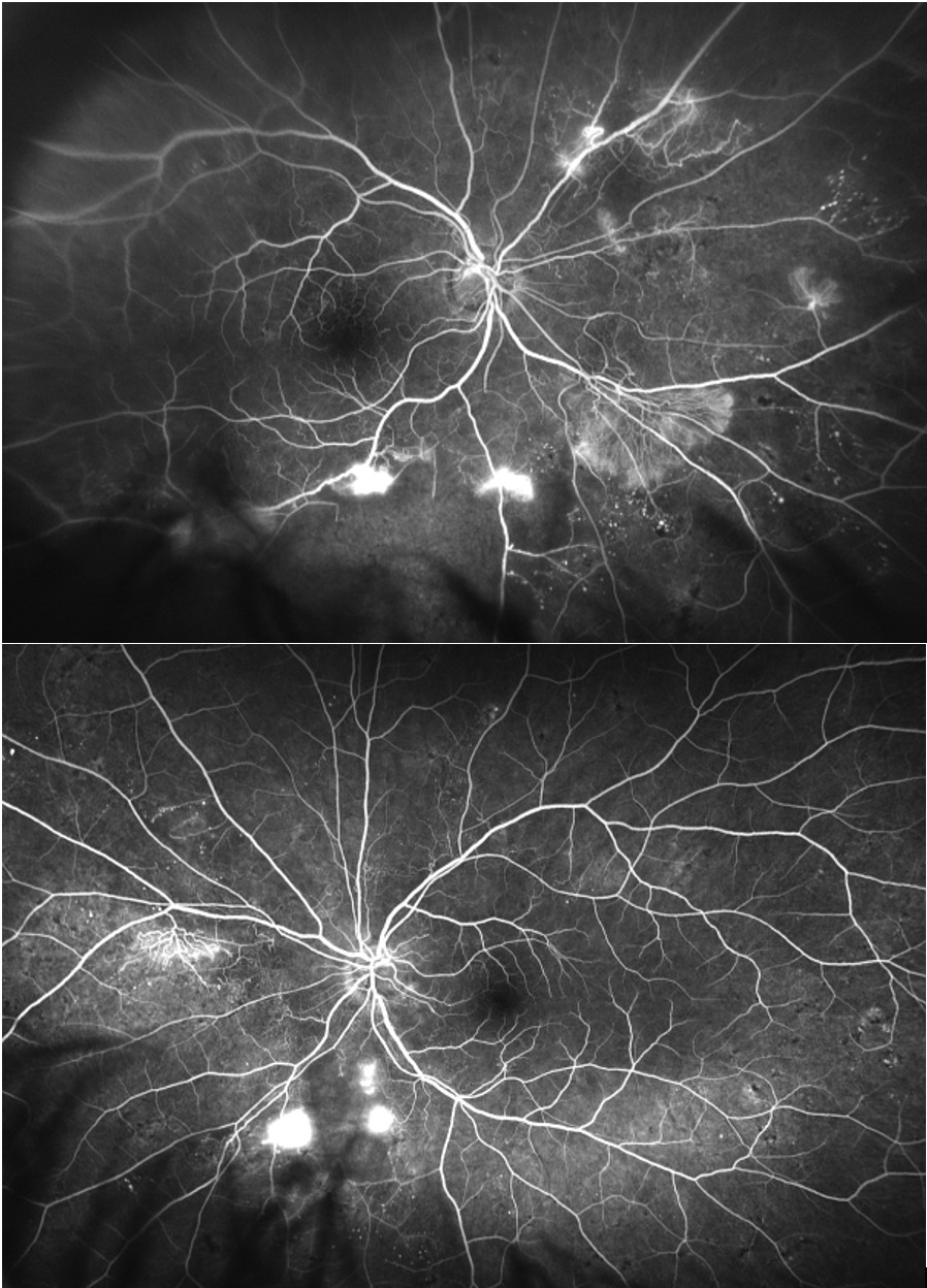 A Case Report of Proliferative Hypertensive Retinopathy | Published in ...