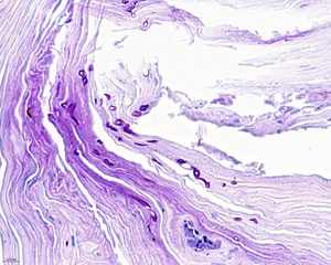 Recurrent Cutaneous Fusariosis in a Kidney Transplant Recipient – a ...