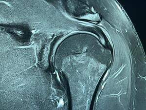 Four Common Upper Body Injuries in Tennis Players: Prevention ...