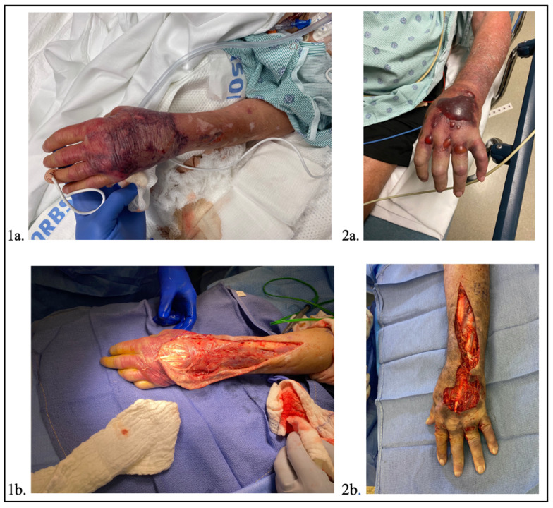 leg necrotizing fasciitis treatment