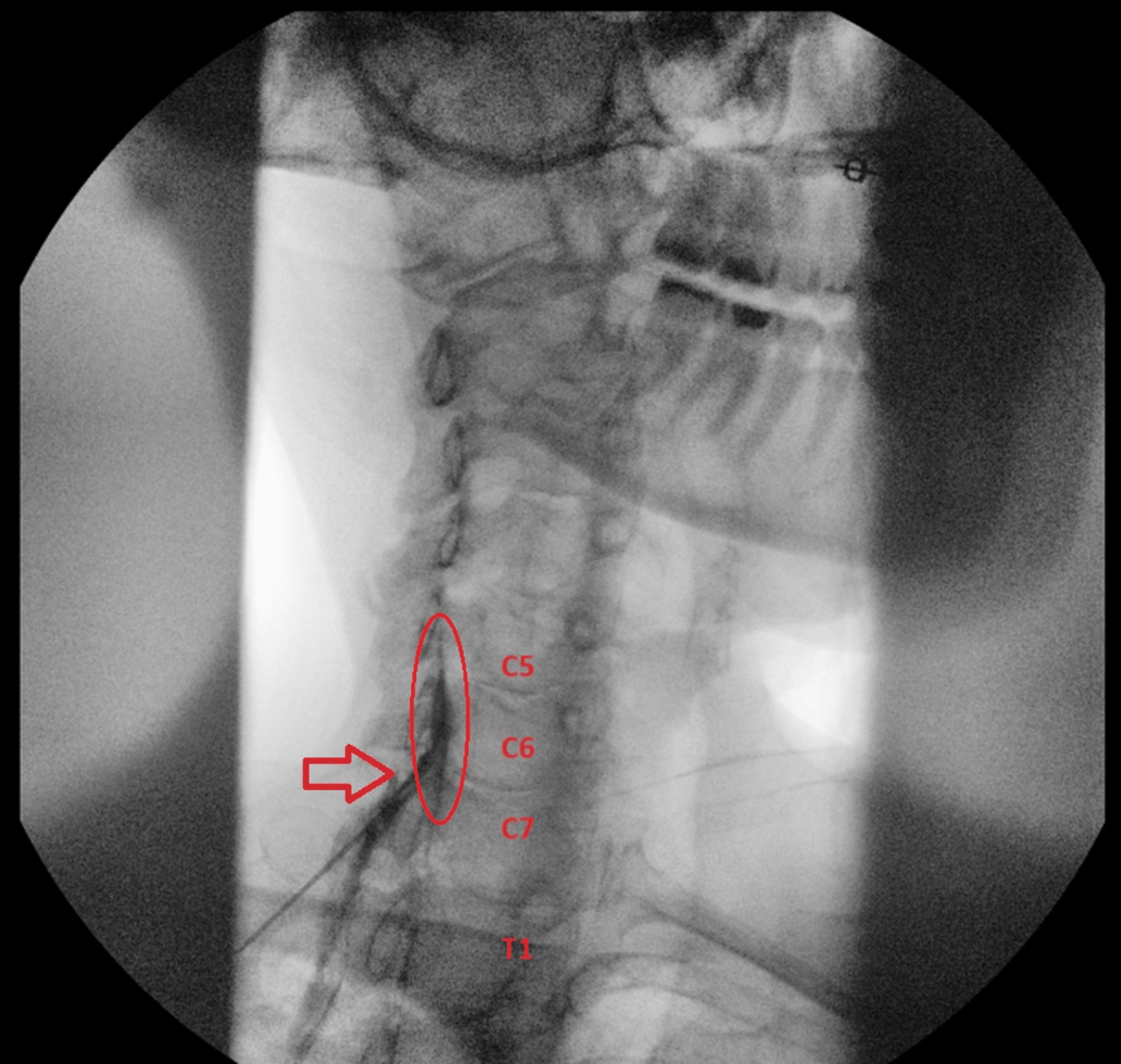 Optimizing Cervical Epidural Steroid Injections: A Case Report ...