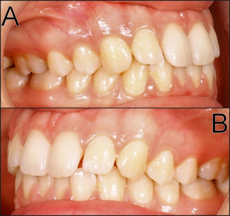 Characteristics Of Static And Excursive Occlusal Parameters In Subjects ...