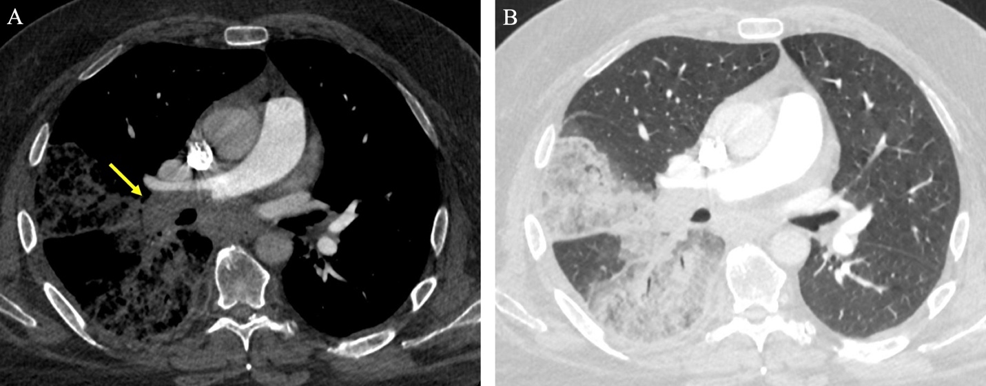 Pulmonary Infarction Due to Direct-acting Oral Anticoagulant ...