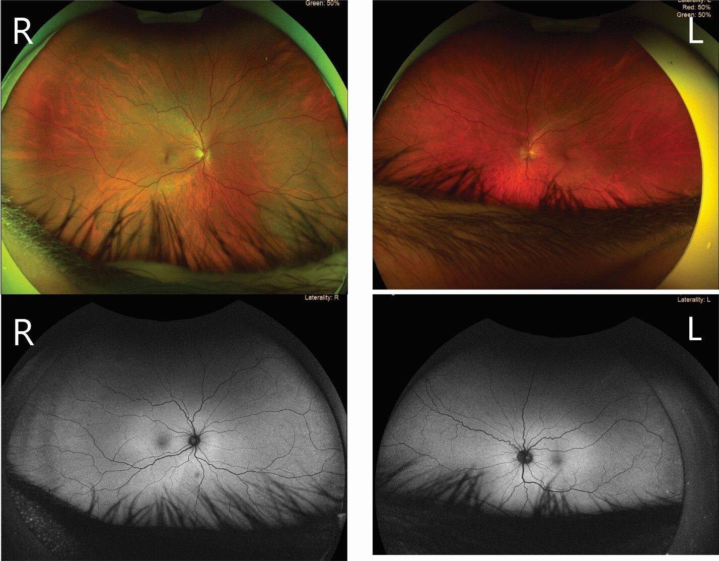 Anterior Diffuse Scleritis: A Case Report and Review | Published in CRO ...