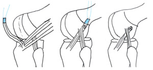 Why Your Patient May Need an ACL Reconstruction Plus Lateral Extra ...