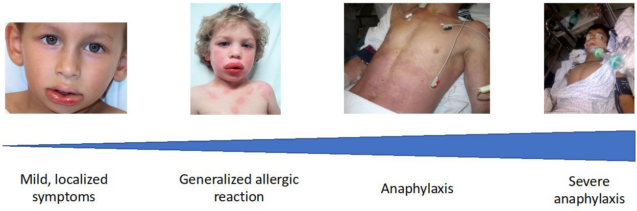 Using NHS Data to Monitor Trends in the Occurrence of Severe, Food ...