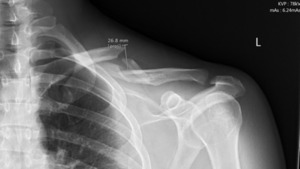 Managing Recurrent Clavicle Nonunion and Construct Failure: A Case ...