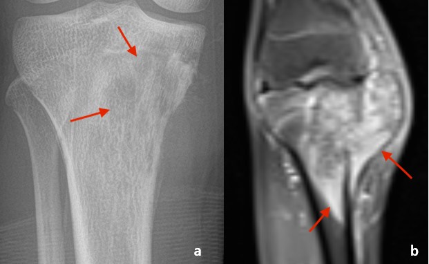 Top 10 Facts to Know about Bone Lesions Identified on Radiographs ...