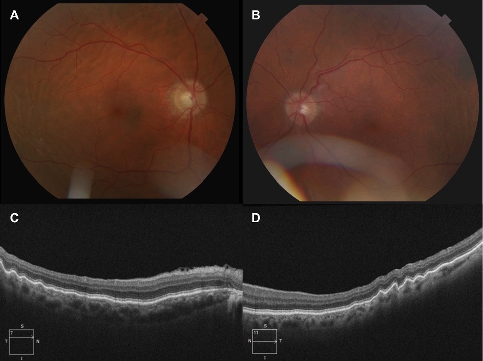 choroidal crescent eye