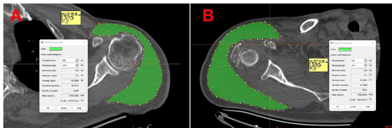 Association between Deltoid Muscle Density and Proximal Humeral ...