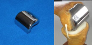 Medial Stabilised Total Knee Arthroplasty: Definition and Performance ...