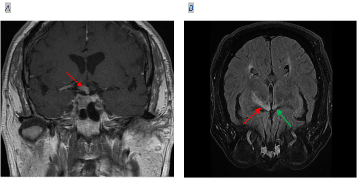 Case Report: Posterior Radiation Optic Neuropathy | Published in ...