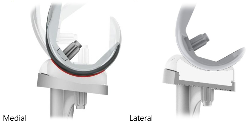 Medial Stabilised Total Knee Arthroplasty: Definition and Performance ...