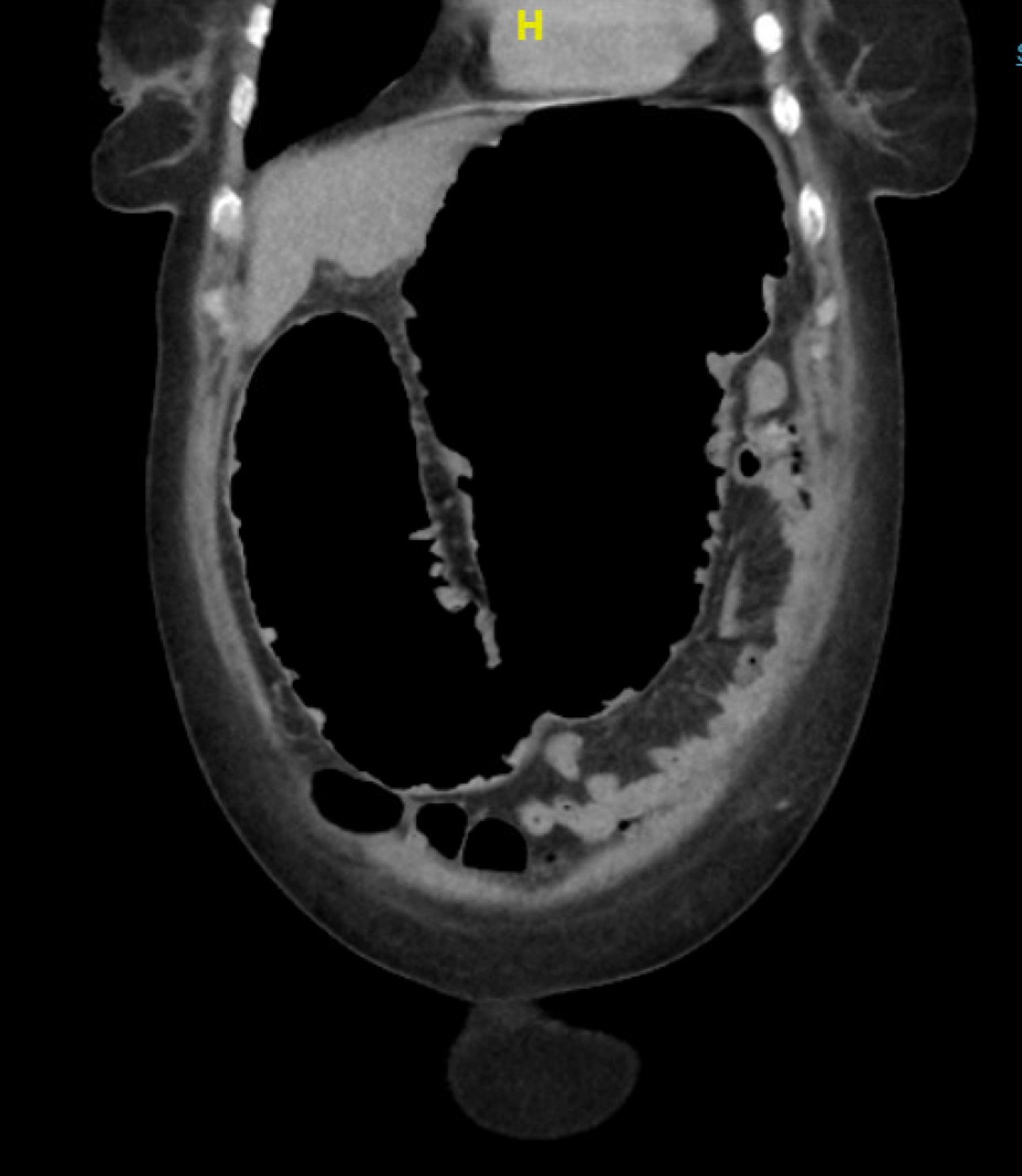 toxic megacolon after c diff