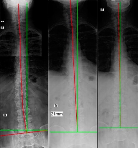 REDUCING ‘CROOKED’ LATERAL SPINE SUBLUXATION (GLOBAL CORONAL IMBALANCE ...