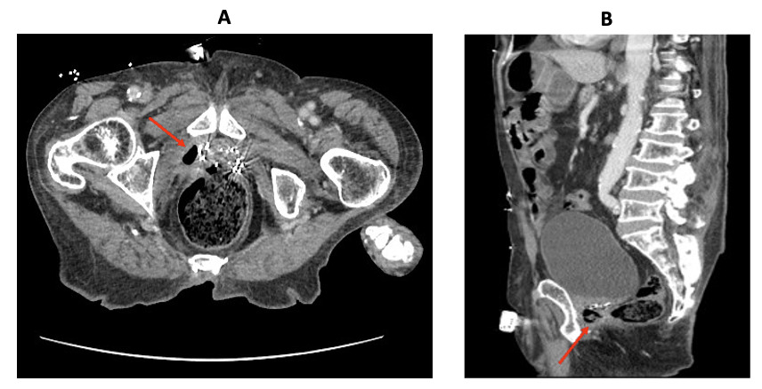 Rectal perforation 19 years after seed brachytherapy for prostate ...