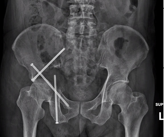 Skeletal Metastases of the Pelvis and Lower Extremity: A Review for the ...