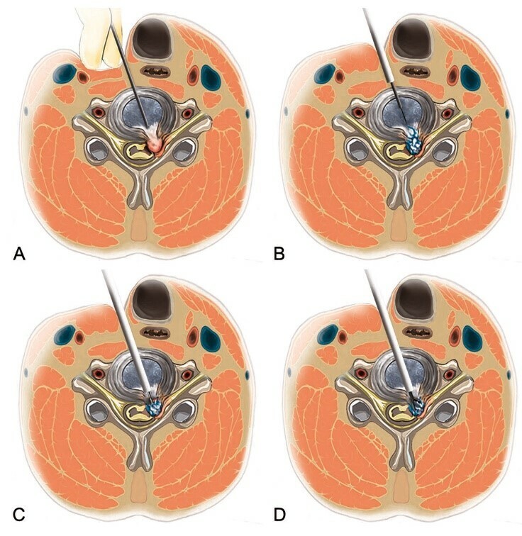 Interventional Therapy and Surgical Management of Lumbar Disc ...