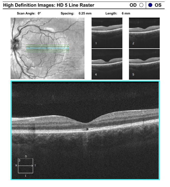 Laser Pointer Retinopathy: A Case Report and Review | Published in CRO ...