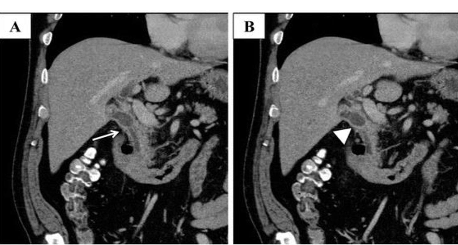 An overview of the management of gallbladder perforations. | Published ...