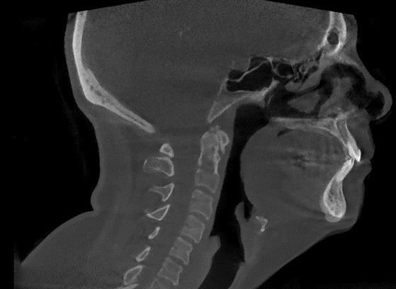 CONE BEAM COMPUTED TOMOGRAPHY: TECHNOLOGY OVERVIEW, DOSE, AND UTILITY ...