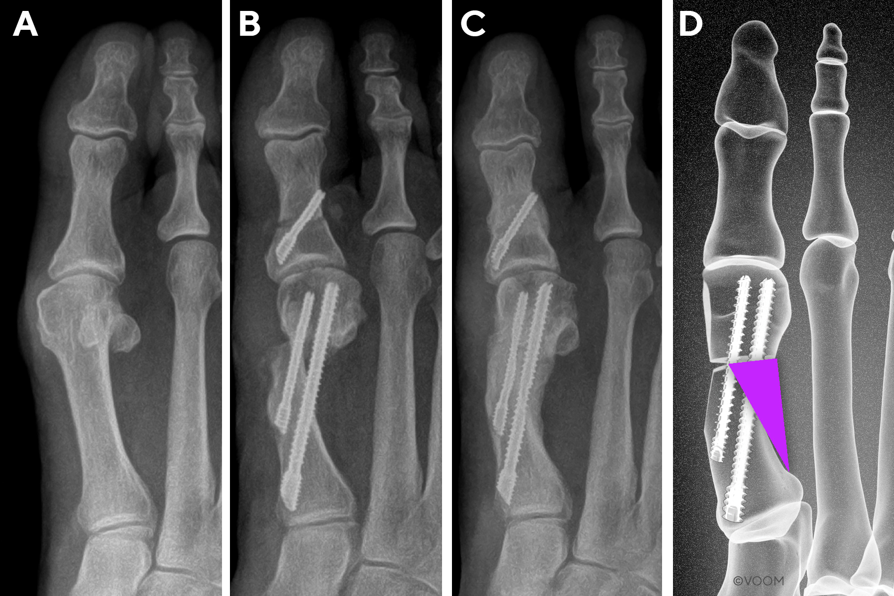 Characterization Of First Metatarsal Regeneration After New Modern ...