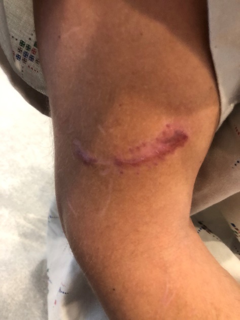DIAGNOSIS OF MULTIPLE SENSORY NEUROPATHIES VIA ELECTRODIAGNOSTIC ...