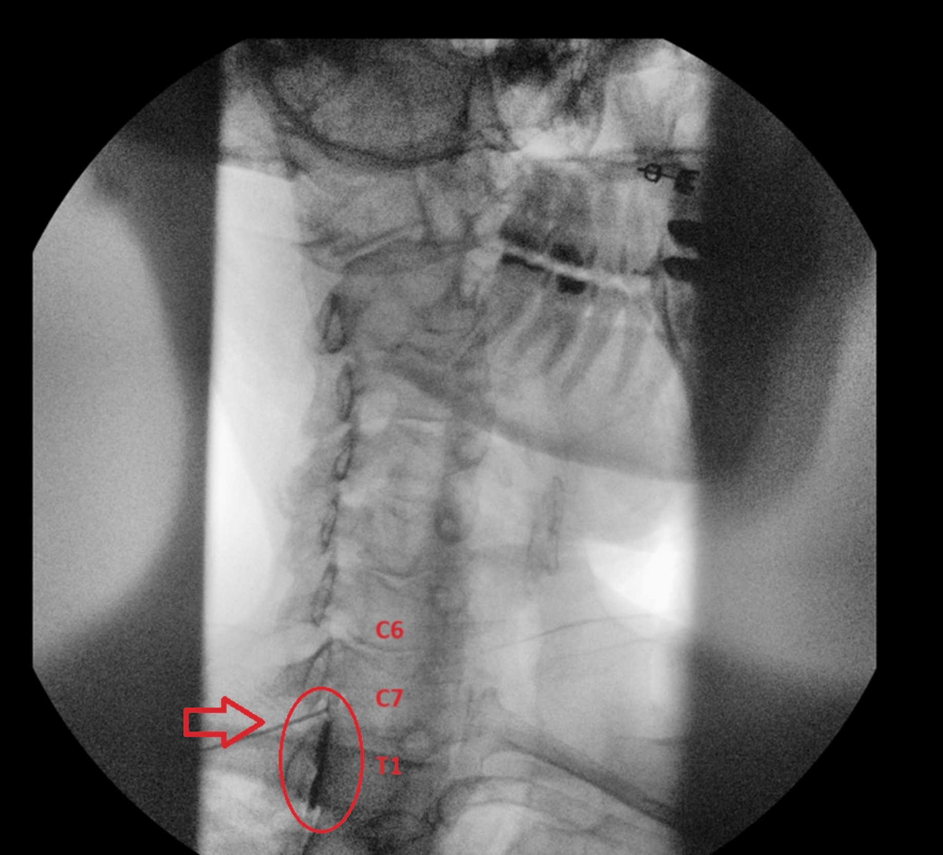 Optimizing Cervical Epidural Steroid Injections: A Case Report ...