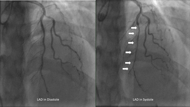 Extensive Myocardial Bridging Treated with CABG | Published in Journal ...