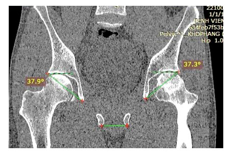 Morphological Characteristics of the Vietnamese Adult Human Acetabulum ...